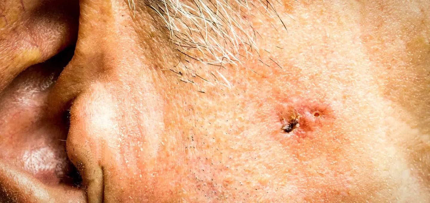 Nodular Basal Cell Carcinoma Uk